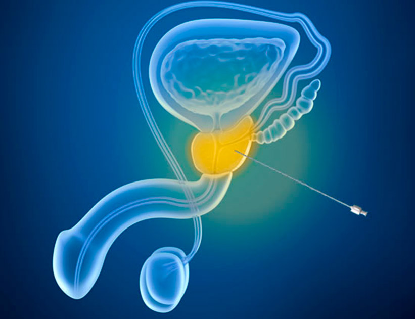 Radiacao Para Tratamento De Cancer De Prostata Técnicas De